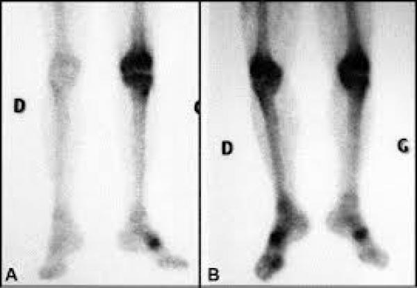 Algoneurodystrophie - GeReMI