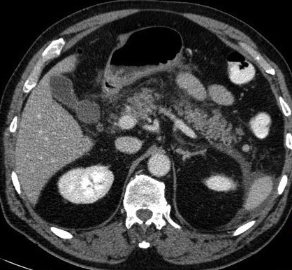 Pancréatite aiguë - GeReMI