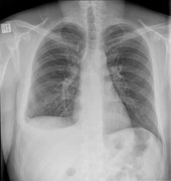 Epanchement pleural - GeReMI