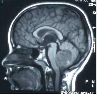 Medulloblastoma Cause