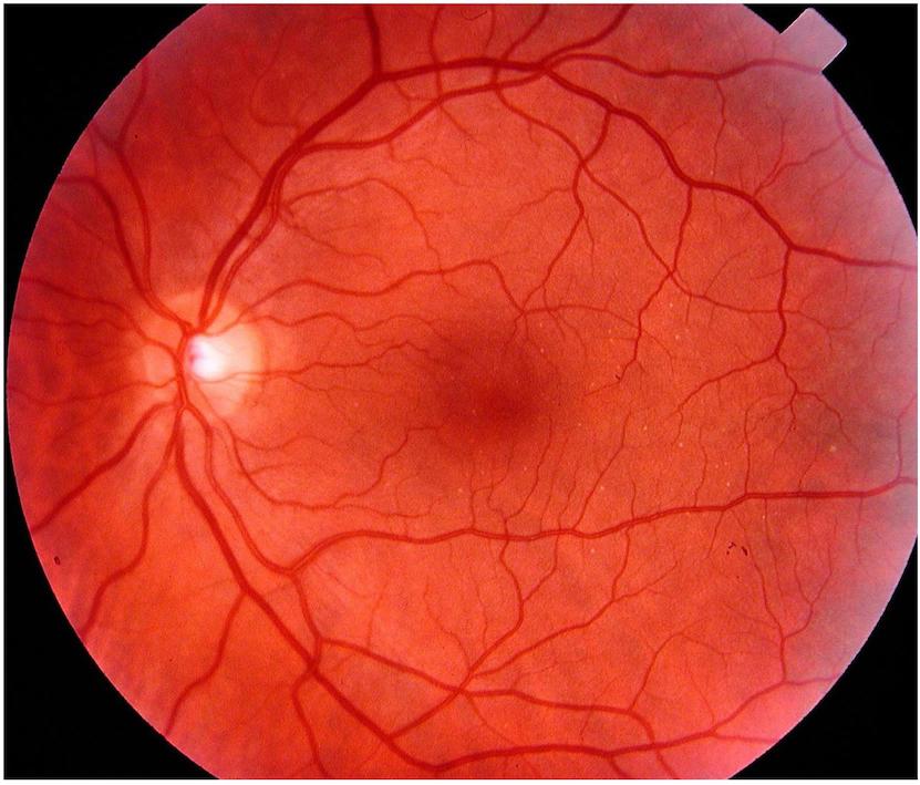 Fond d'oeil normal - GeReMI