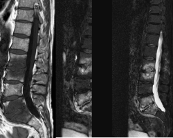 Spondylodiscite - GeReMI