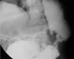 Sténose colique - GeReMI