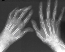 Algoneurodystrophie - GeReMI