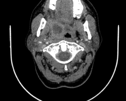 Phlegmon de l'amygdale - GeReMI