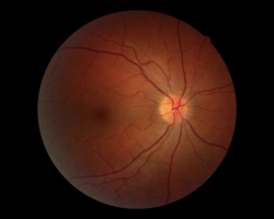 Fond d'oeil normal - GeReMI