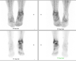 Algoneurodystrophie - GeReMI